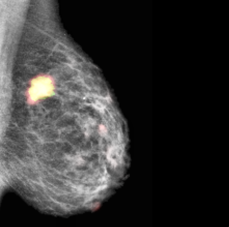 Detection and Classification of Lesions in Mammograms with Deep Learning - Emoda Yazılım